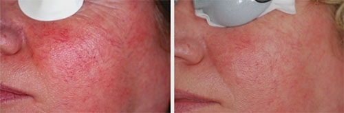 Couperose et rougeurs traitement laser à Conches près d'Evreux (27)